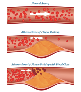 Atherosclerosis - The Heart Foundation