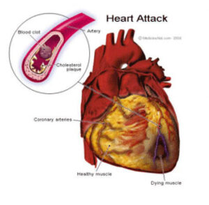 WHAT IS HEART DISEASE? - The Heart Foundation